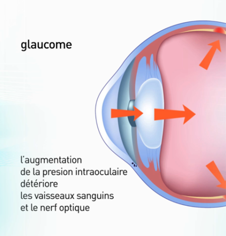 Ophtalmo Paris - Chirurgie du glaucome Paris - Ophtalmologue Paris